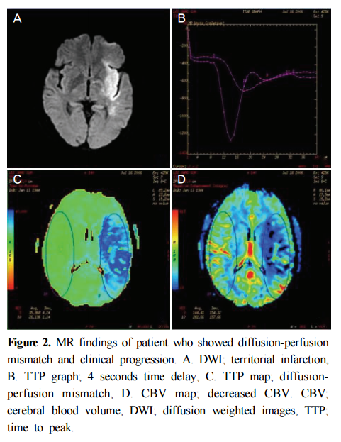 ::햇빛의료판례:: > 용어사전 > Diffusion-Perfusion Mismatch, 확산-혈류 불일치, 확산-관류 불일치